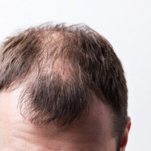 Cortes de pelo y peinados para hombres con entradas o calvicie